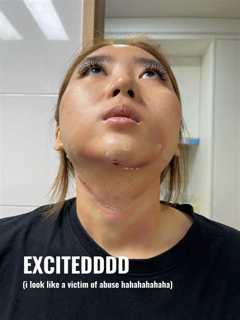 🇰🇷 Post Op Day 1 Updates On My Surgery 😌 Gallery Posted By Zara Lim