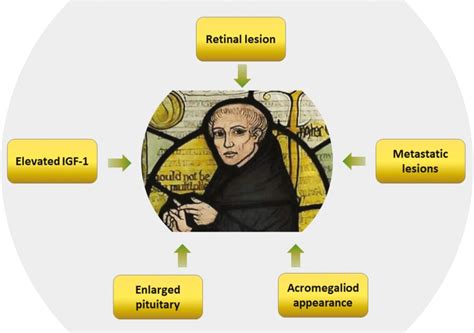 Ockhams Razor For A Retinal Lesion And Acromegaly And Breaking The Vicious Circle Abstract