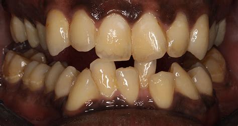 Smile Makeover Before And Afters Beverly Hills Cosmetic Dentistry