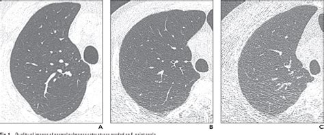 Figure 1 From Ultra Low Dose Ct Of The Thorax Using Iterative Reconstruction Evaluation Of