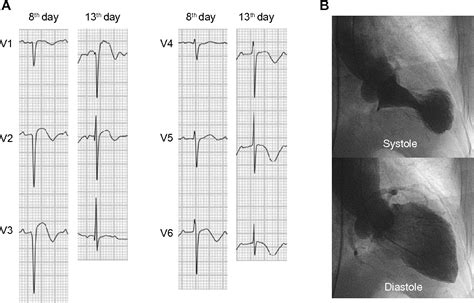 Figure 3 From Electrocardiographic Findings In Takotsubo Cardiomyopathy