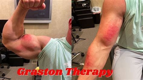 What Is Graston Shoulder Relief How To Use Graston Technique Youtube
