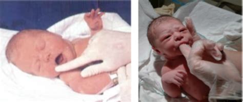 Newborn Assessment Flashcards Quizlet