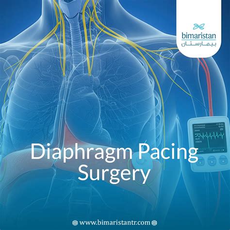 Diaphragm Pacing Surgery A Breakthrough In Respiratory Tech