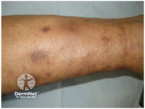 Dermatological Manifestations Of Diabetes Mellitus And Its Complications