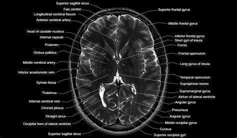 Frontal Operculum Axial