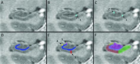 Segmentation Of Hippocampal Subfields Using In Vivo Mri Subfield