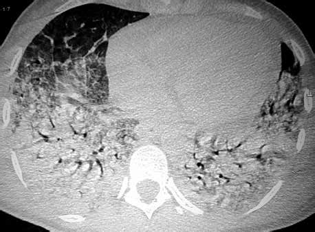 Chest CT Showing Bilateral Alveolar Opacities Suggestive Of Alveolar Download Scientific