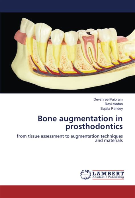 Bone Augmentation In Prosthodontics From Tissue Assessment To