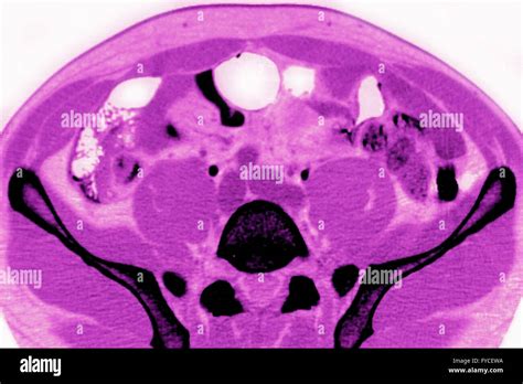 Ct Scan Abdomen High Resolution Stock Photography And Images Alamy