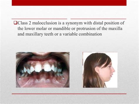 Class Ii Division 1 Malocclusion Pptx Dental Health Diseases And