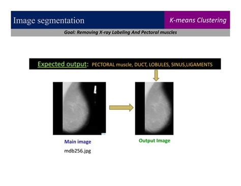 Microcalcification Identification In Digital Mammogram For Early