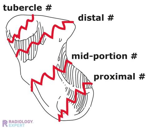 Scaphoid Fracture Classification