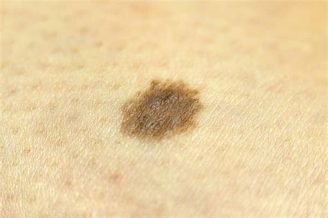 Рак Кожи Проявления