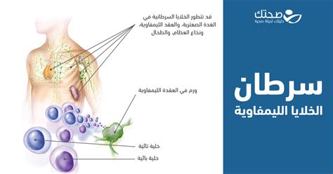 سرطان الغدد اللمفاوية كل ما تحتاج معرفته عن هذا المرض