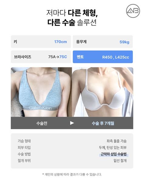 에이비성형외과 가슴성형 중요한 건 단순한 크기보다 👉 체형맞춤 설계 김수정 원장이 직접 집도하는 Abcde 체형맞춤 가슴성형은 수천 건 이상의 수술 데이터를 기반으로