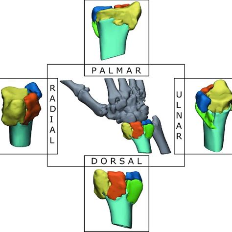 3d Fracture Model Of The Distal Radius Of Patient 1 The Central Image