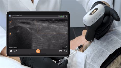 Jawline And Temporal Injections Clarius