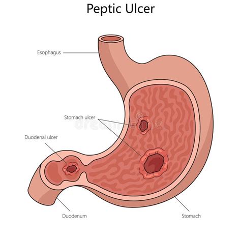 Peptic Ulcer Disease Structure Medical Science Stock Illustration Illustration Of Anatomical