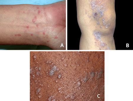 Lichen Planus Symptoms Causes Treatment 1024x768