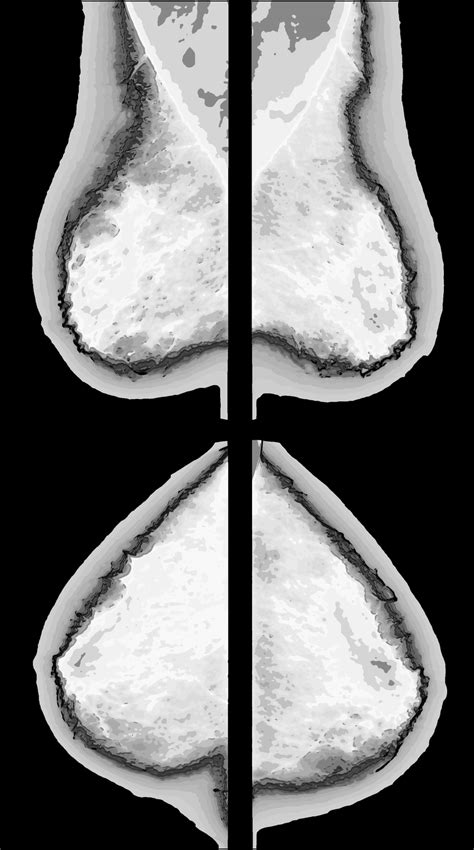 Segmentation Of The Mammogram According To Mixture Model Components Download Scientific