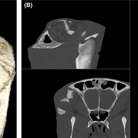 A Ct 3‐d Reconstruction Of The Depressed Comminuted Fracture Of The Download Scientific