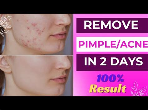 How To Get Rid Of PIMPLES In Just Days Pimplesremoval YouTube