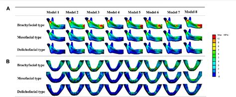 Figure 1 From The Effect Of Mandibular Flexure On The Design Of Implant Supported Fixed