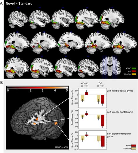 Processing Of Novel Visual Stimuli A Activation Overlap Between Download Scientific Diagram