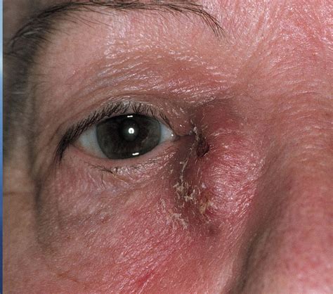 Filedacryocystitis Eyewiki