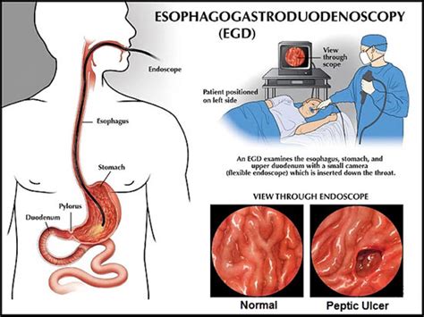 Medical Terminology EGD Medical Terminology Blog
