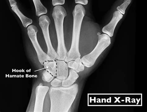Hamate Dislocation