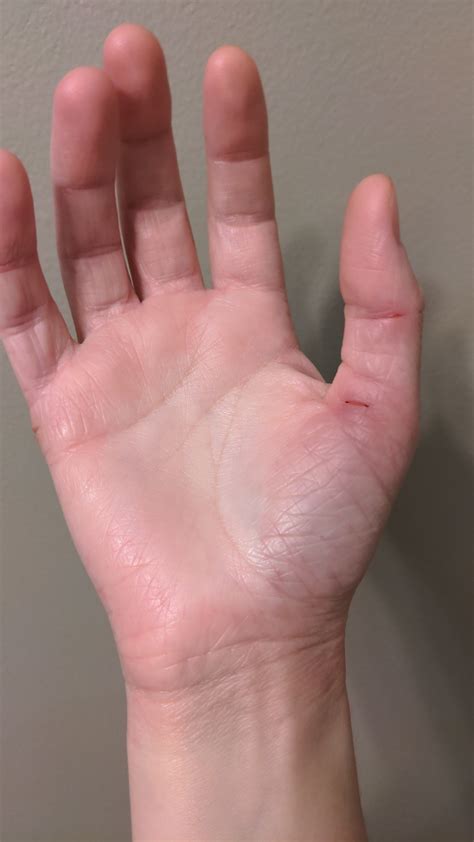 Possible Early Symptoms Rscleroderma