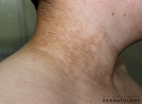 5 Warning Signs That Cancer May Be Coming But Few People Notice