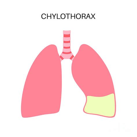 Chylothorax 12 By Pikovit Science Photo Library