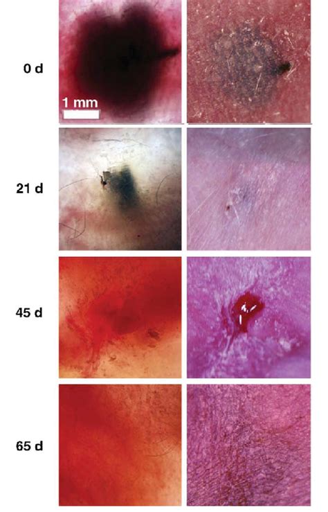 Complete Regression Of Melanoma Evident By 65 Days After The First Download Scientific Diagram