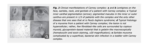 Carney Complex สมาคมต่อมไร้ท่อแห่งประเทศไทย