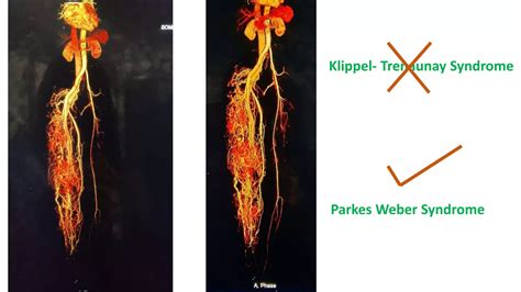 Parkes Weber Syndromepptx