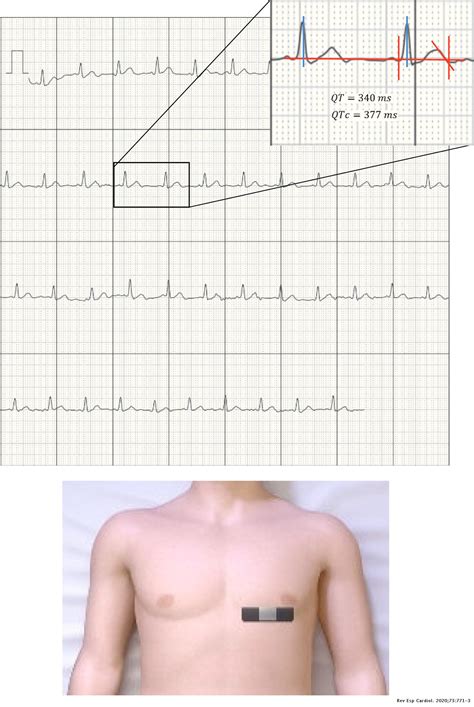 Electrocardiographicqt Interval Monitoring With A Portable Device In