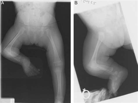 Ap A And Lateral B Radiographs Of A 13 Year Old Patient With