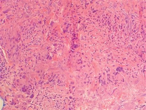 Erythema Annulare Centrifugum Histology