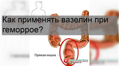 Как применять вазелин при геморрое? - YouTube