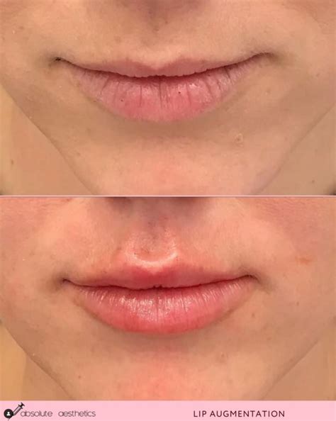 Juvéderm Facial Fillers In Plantation Fl Med Spa