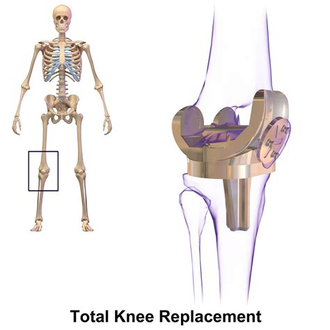Categoryknee Replacement Wikimedia Commons