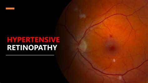 Hypertensive Retinopathy 2pptx