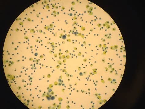 Macrophage Pleural Fluid