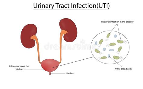 Urinary Tract Infection Uti Vector Illustration Stock Vector Illustration Of Vector