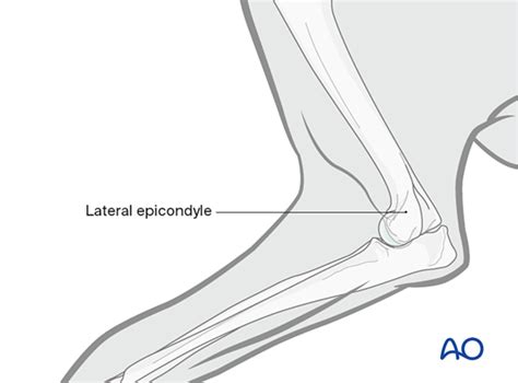 Lateral Approach To The Dog Distal Humerus