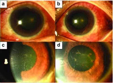 Patients Right A And Left B Eyes With Nonnecrotising Diffuse