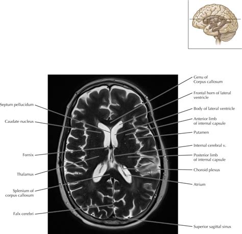 Ventricular Anatomy Brain
